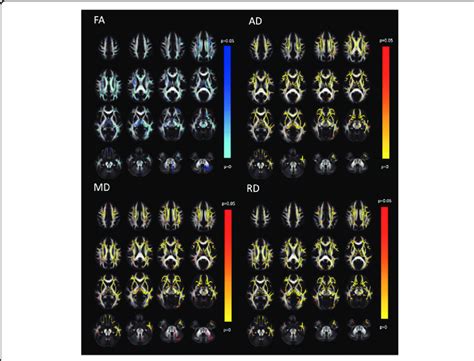 Diffusion Tensor Imaging DTI Of Patients With Mild Traumatic Brain Download Scientific
