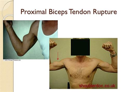 Ppt The Shoulder Powerpoint Presentation Id2176745