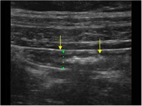 Abdomen And Retroperitoneum 1 5 Appendix Case 1 5 2 Uncomplicated