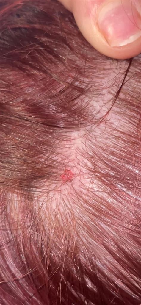 Small Scab And Firm Bump 1 Year Old Rmedicaladvice