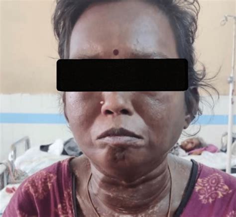 A Rare Case Of Polymyositis And Systemic Sclerosis Overlap Syndrome