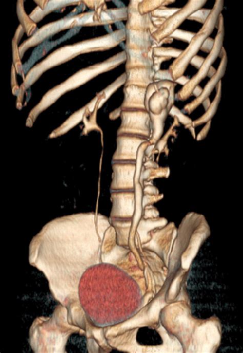 Duplicated Ectopic Ureter With Vaginal Insertion 3d Ct Urography With