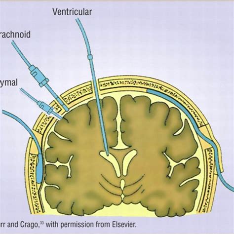 Stream Intracranial Pressure Monitoring Pdf Download By Lisa Listen
