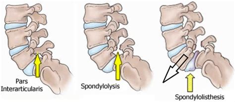 Spondylolisthesis Causes Symptoms Diagnosis Grades Treatment