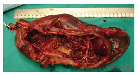 The Surgical Specimen After Total Splenectomy Containing The Spleen And Download Scientific