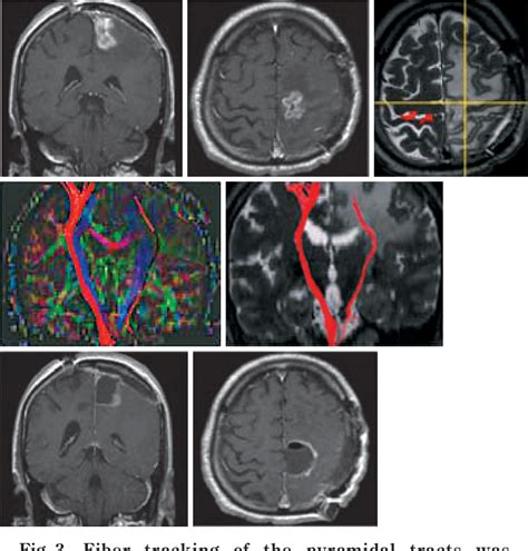 Figure 1 From Monitoring Brain Function During Neurosurgery Semantic Scholar