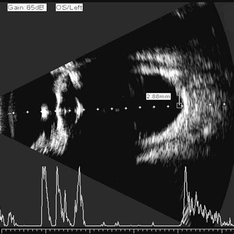 Figure1firstqualitycontrolmeasureforimmersionb Scan Ultrasoundbiometry Download Scientific