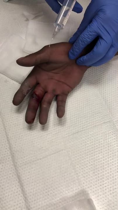 Video Patrick Omalley On Linkedin Intrathecal Digital Nerve Block
