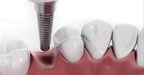다양한 임플란트 재료 어떤 걸 써야 할까