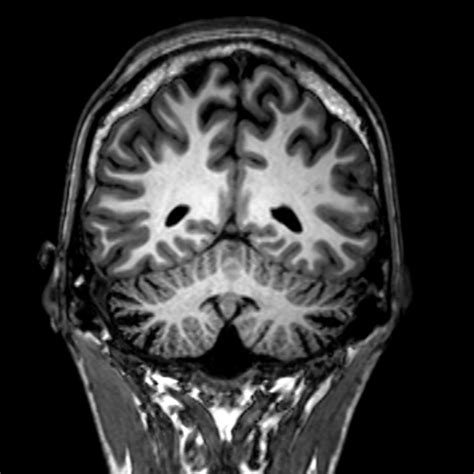 Bilateral Symmetrical Frontal Polymicrogyria Eurorad