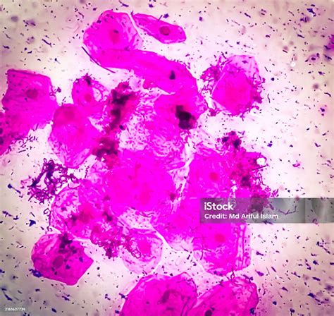 Epithelial Cells Clue Cells And Neisseria Gonorrhoeae Micrograph Stock