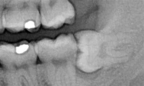 Can My Erupted Wisdom Teeth Be Saved Rorthotropics