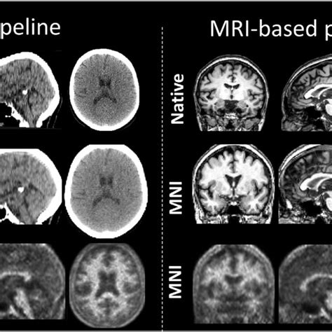 Images Of The Normalization Methods In A Representative Patient Left Download Scientific