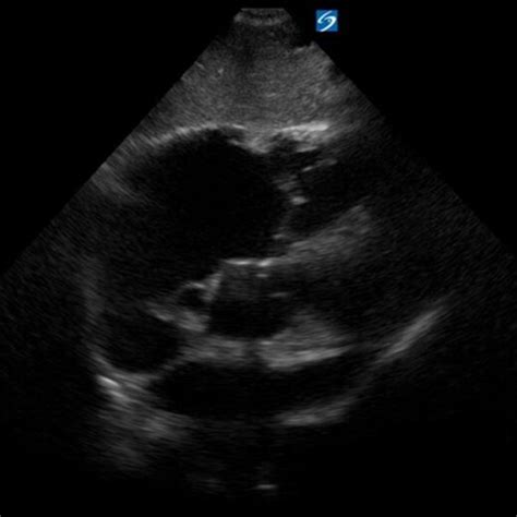 Subxiphoid Shows Extremely Enlarged Right Atrium Which Can Also Be