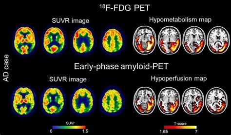 Sofie Auf Linkedin New Dual Phase Imaging Protocol Reduces Costs And Radiation Exposure For…