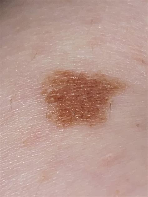 It Keeps Growing Rmelanoma