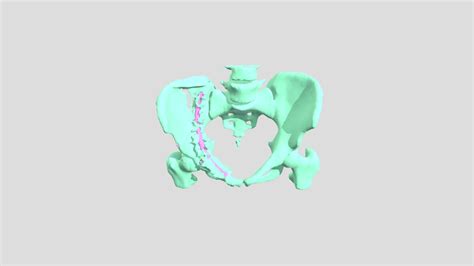 broken hip segmentation exam 3 download free 3d model by katspencer