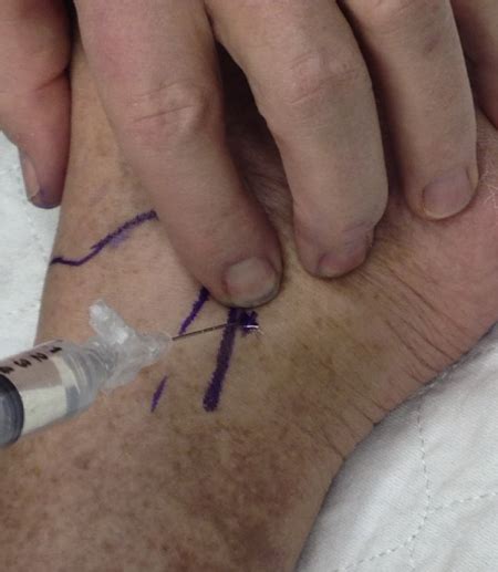 Diagnostic Posterior Tibial Nerve Block Sports Medicine Review