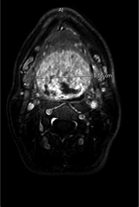 Contrast Enhanced Axial T1 Weighted Magnetic Resonance Imaging Showing