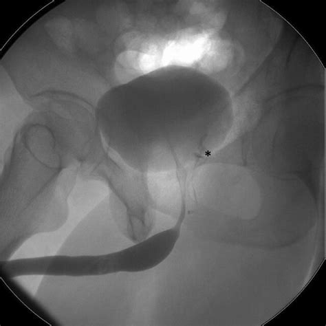 Retrograde Urethrogram Shows Opacification Of The Urethra And Bladder Download Scientific