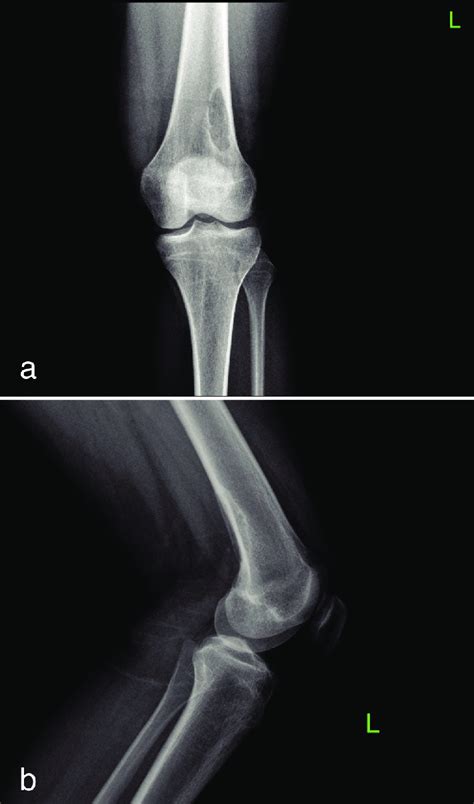 Knee Radiographs Of A 15 Year Old Patients Non Ossifying Fibroma Of Download Scientific