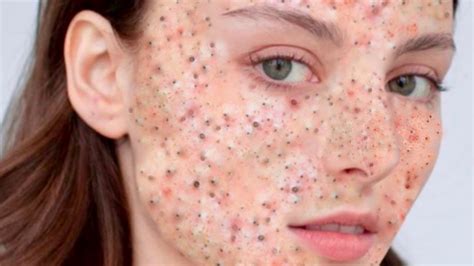Pimple Popper And Blackhead Removal Best Pimple Popping Compilation