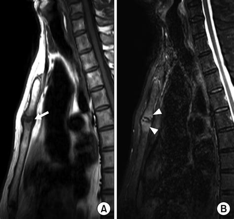 Manubriosternal Joint