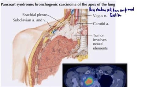Pulm Nodules And Lung Cancer Flashcards Quizlet