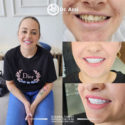 Dr “another Happy Patient With A Dazzling Smile Join The Dr Assi