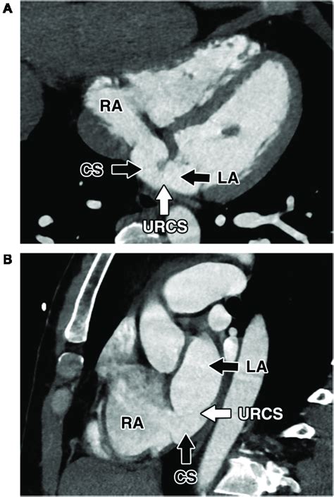 Preoperative Cardiac Computed Tomography Computed Tomography Showed Download Scientific