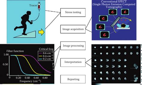 4 Stress Myocardial Perfusion Spect Download Scientific Diagram