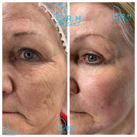 Co2 Laser Resurfacing Before And After Cnxjd