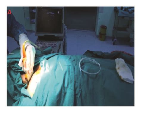 Venous Intervention Through Usg Method Jugular Vein Is Out Of Plane