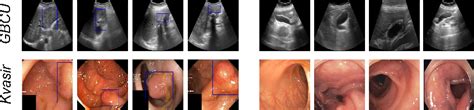 Figure 2 From Gall Bladder Cancer Detection From Us Images With Only Image Level Labels