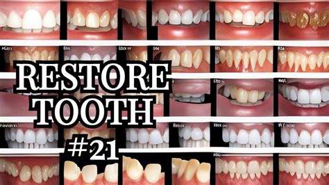 Avoid These Mistakes Class Ii Restoration Tooth 21 Teeth Cavity