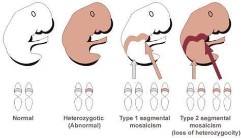 Brasil Cutaneous Mosaicisms Concepts Patterns And Classifications