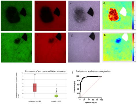 Differentiation Of Nevi From Melanomas With The Use Of Parameter S A