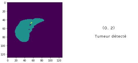 Github Najoua Zeffate Cancer Liver Detection This Project Aims To Detect Liver Cancer Using