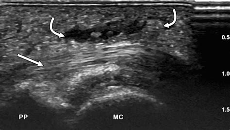 Central Metatarsalgia And Walking On Pebbles Beyond Morton Neuroma Ajr