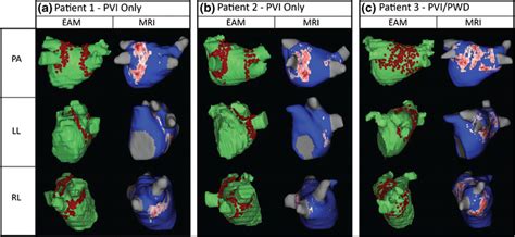 Ac Comparison Of Ablated Area Marked On Eam Left Column And Scar On Download Scientific