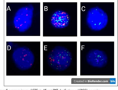 Figure 1 From Prognostic Significance Of Excision Repair Cross Complementation Group 1 On