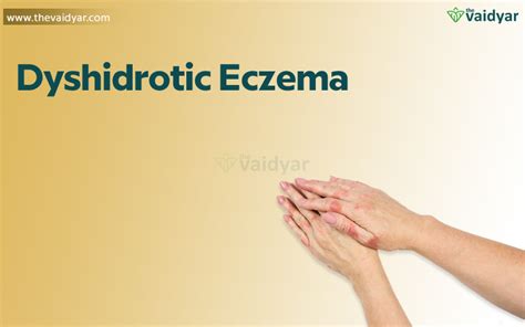Ayurvedic Herbal Remedies For Dyshidrotic Eczema