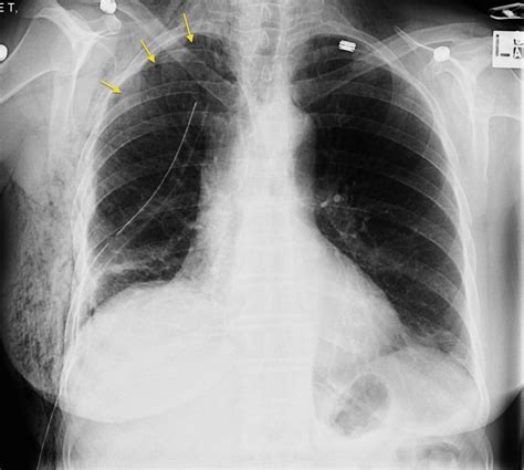 Pneumothorax And Surgical Emphysema Radiology At St Vincents