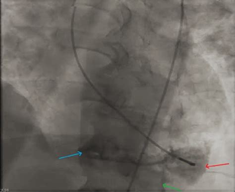 Left Ventricular Angiography The Lao Cranial View 20 ͦ 20 ͦ Shows Download Scientific