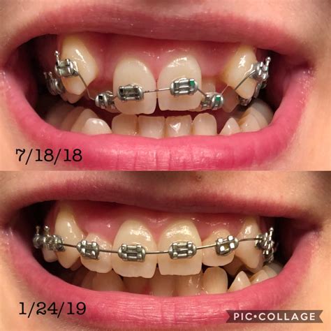 Bottom Braces Going On Soon Rbraces
