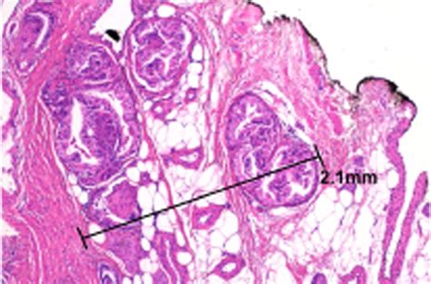 Assessing Extraprostatic Extension With Multiparametric Mri Of The