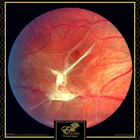 عملية إزالة تليفات مركز الابصار