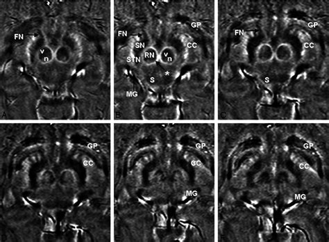 High Quality Swi Phase Images Subject 7 Te ϭ 2071 Ms Sense ϭ 1