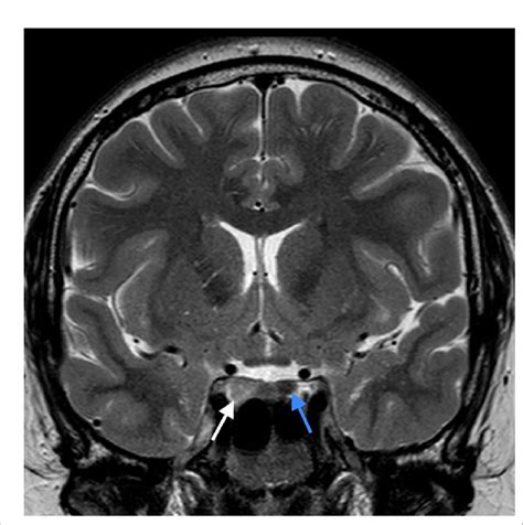 T2 Weighted Image In Coronal Plane Pituitary Adenoma Of The Right Lobe