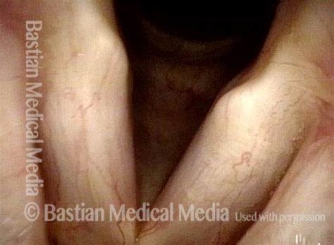 Candida Laryngitis And Pharyngitis A Commensal Organism